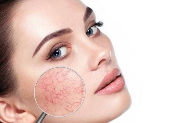 Vbeam Laser: Rosacea Treatment With Minimal Downtime