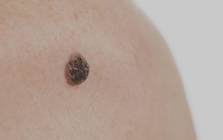 Teleconsultation for Mole Removal – Squamous Cell Carcinoma (Skin ...