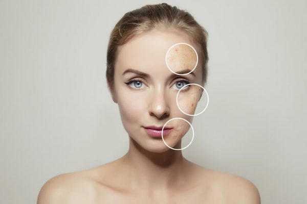 The 4 Stages of Acne: What They Mean & How To Treat Them