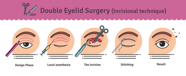 How long does double eyelid surgery / stitching last? - The Clifford Clinic