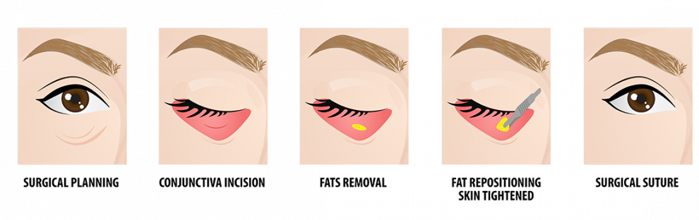 How to Remove Eye Bags - The Clifford Clinic