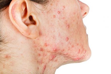 Cystic Acne Treatment In SG – Cure Inflamed, Recurring Acne