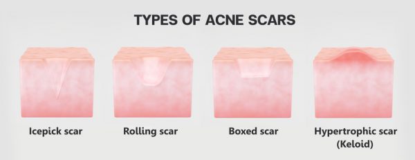 Say Goodbye To Spots: Acne Scar Treatment & Removal In SG