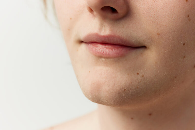 New Moles Appearing On The Face: What Should You Do?