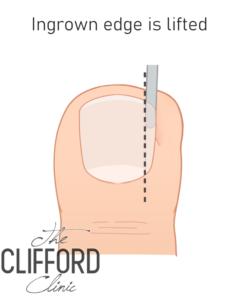 Partial Nail Avulsion - Ingrown Toenail-removal-surgery