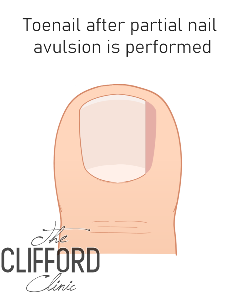 Partial Nail Avulsion - Ingrown Toenail-removal-surgery