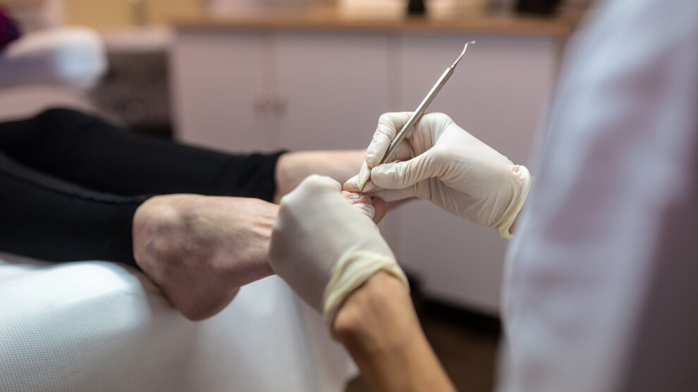 All you need to know about Ingrown Toenail Removal - The Clifford Clinic