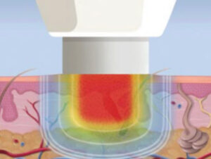 Warts Removal Treatment - The Clifford Clinic