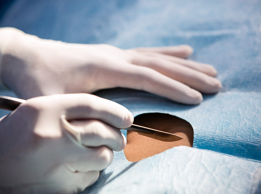 Shang Ring Circumcision in Singapore
