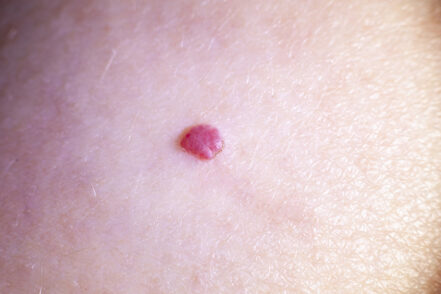 Red Moles or Cherry Angiomas: Are They a Cause for Concern?