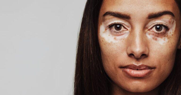 Improve Your Skin's Look With Vitiligo Treatment In Singapore
