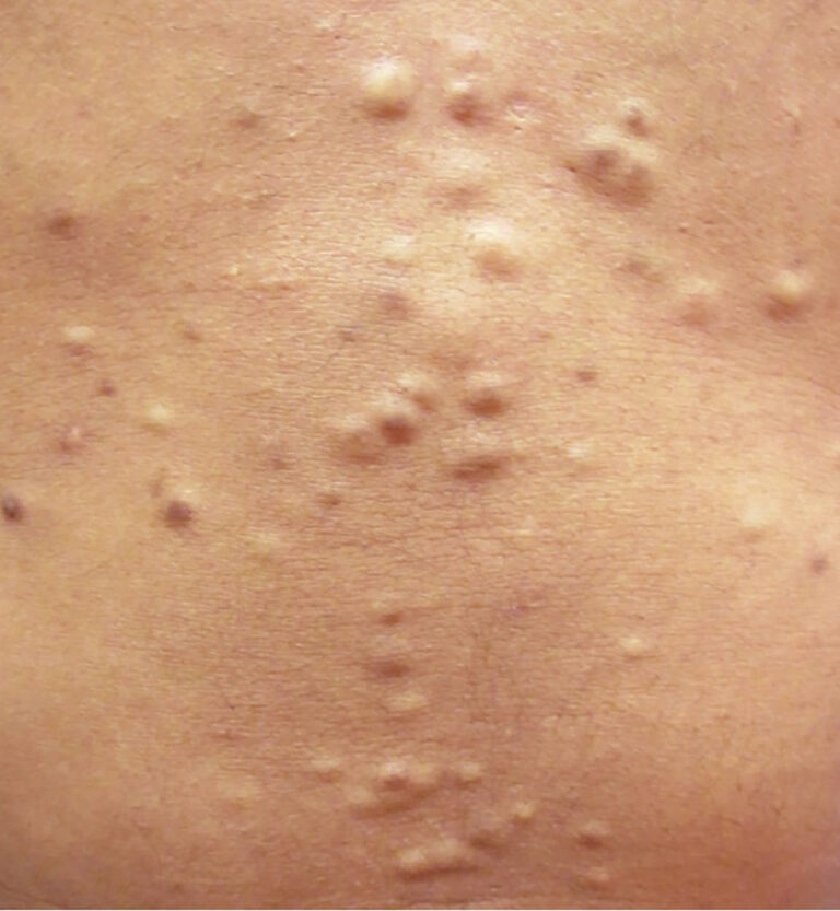 Steatocystoma multiple in Singapore