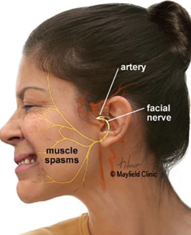 Blepharospasm & Hemifacial Spasm Treatment In Singapore