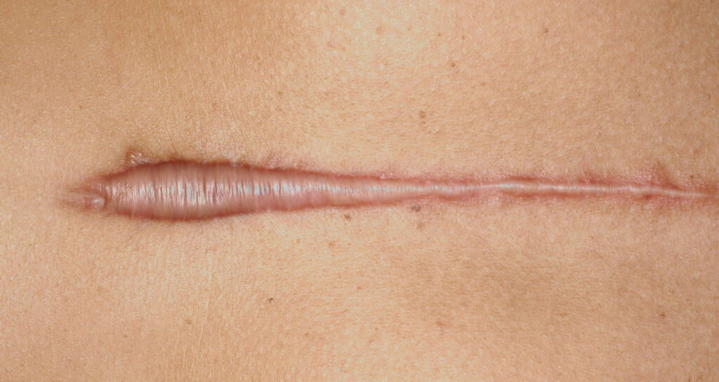 RADIOTHERAPY IN KELOID CARE: EVIDENCE, TECHNIQUES, AND FUTURE ...