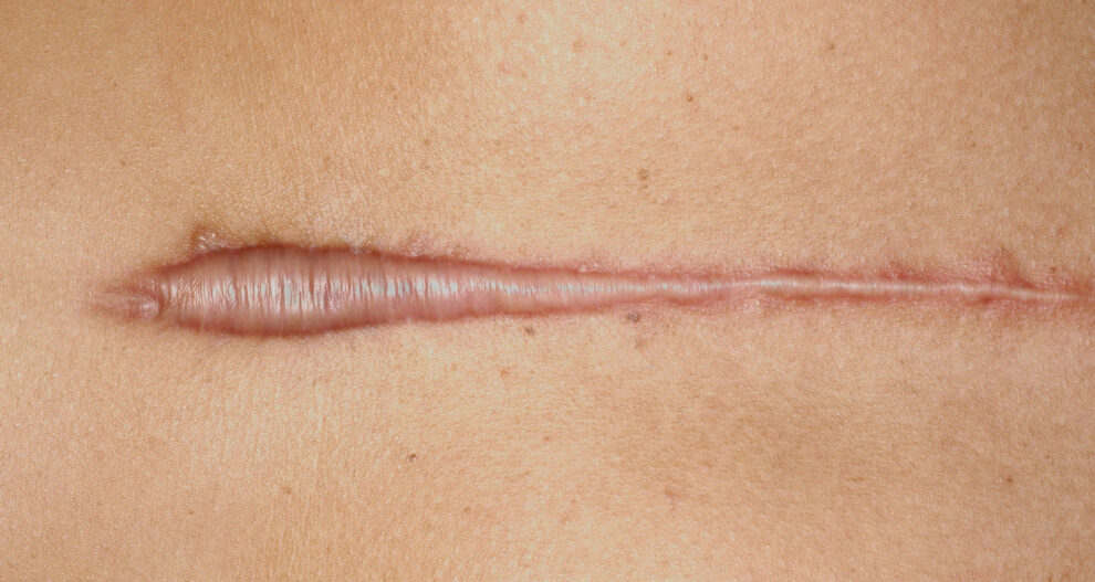 RADIOTHERAPY IN KELOID CARE: EVIDENCE, TECHNIQUES, AND FUTURE ...