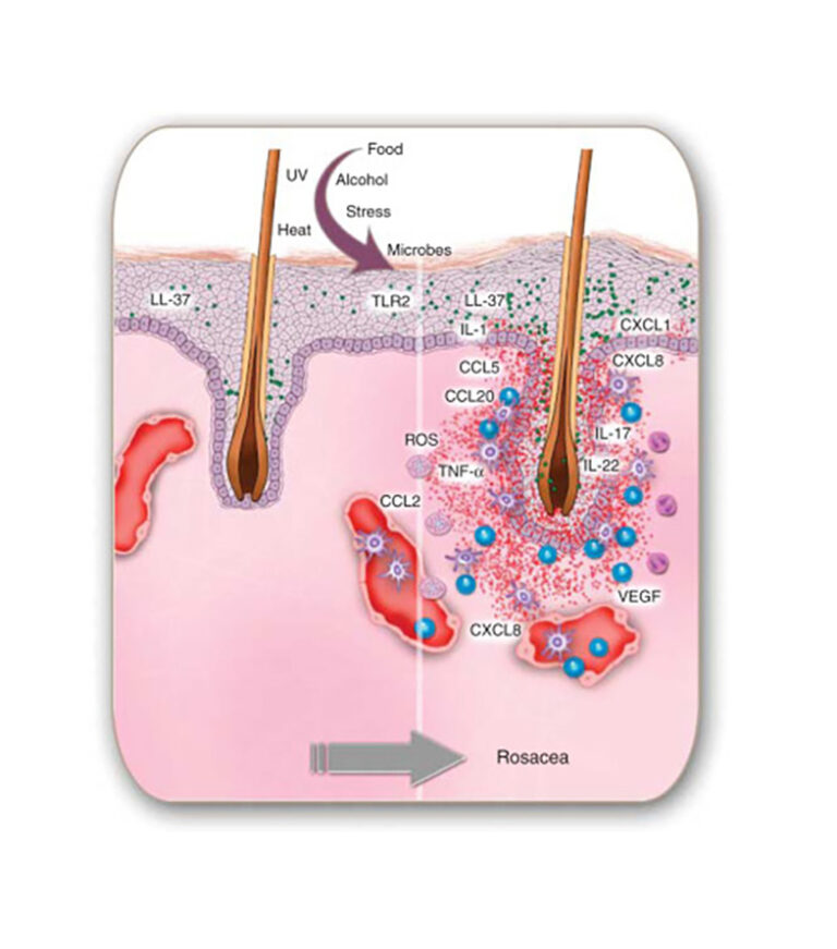 Pyoderma Faciale (Rosacea Fulminans)