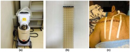 RADIOTHERAPY IN KELOID CARE: EVIDENCE, TECHNIQUES, AND FUTURE ...