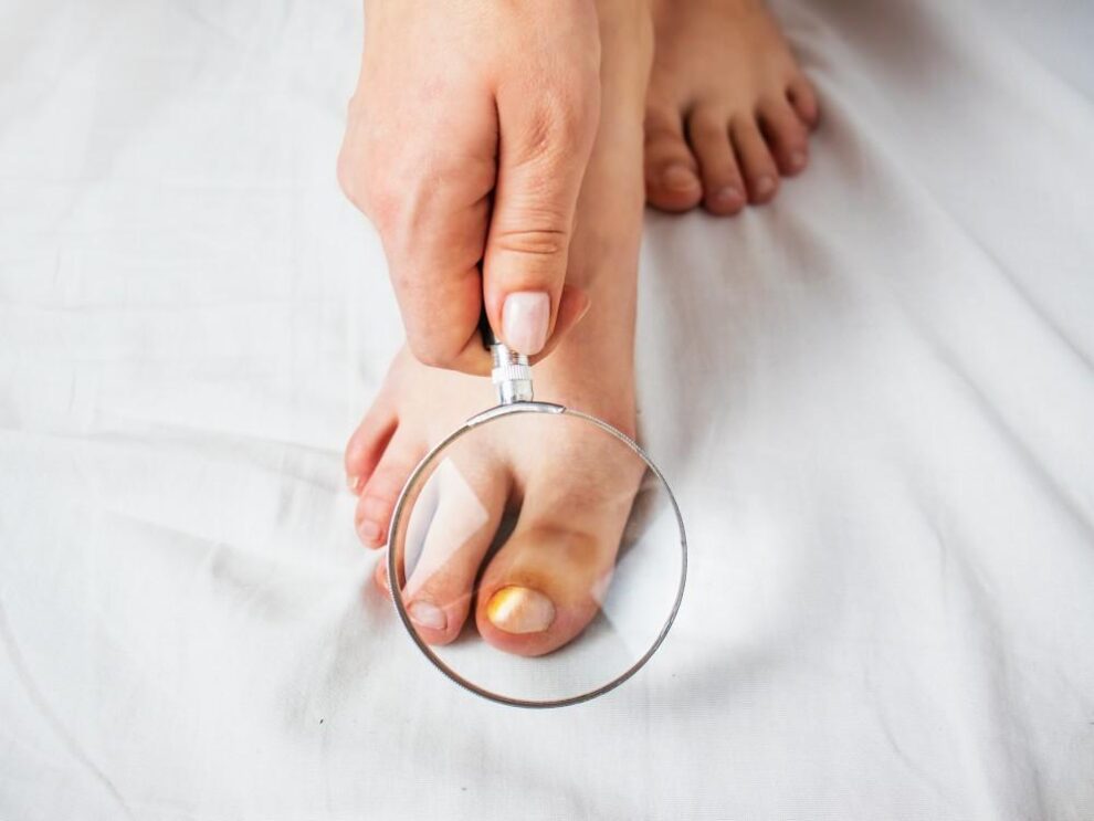 All you need to know about Ingrown Toenail Removal - The Clifford Clinic
