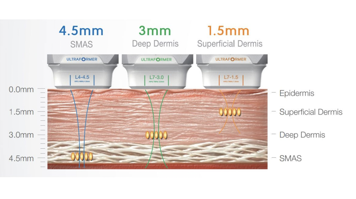 HIFU : Non-surgical Face Lifting in Singapore