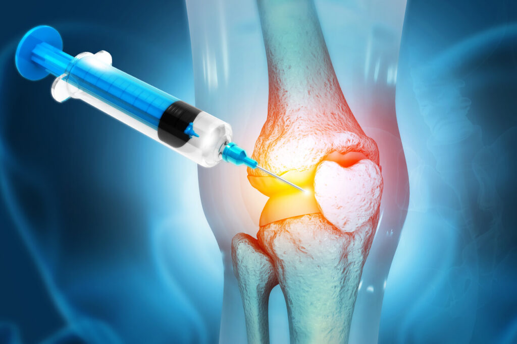 Knee Joint Injection in Singapore: A Practical, Research-Driven Guide ...