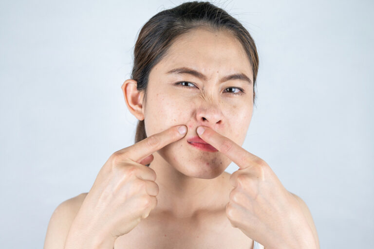 How to Get Rid Of Acne Scars Without Irritating Your Skin - The ...